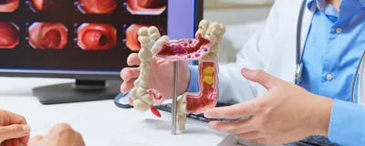 American Cancer Society Updates Colorectal Cancer Screening Guidelines ...