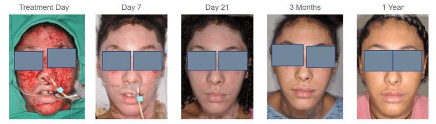 How a Plastic Surgeon Developed a Spray-On Skin Burn Treatment That ...